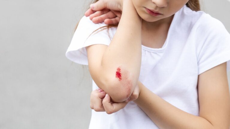Minor Cuts and Wounds: When Are Stitches Needed?